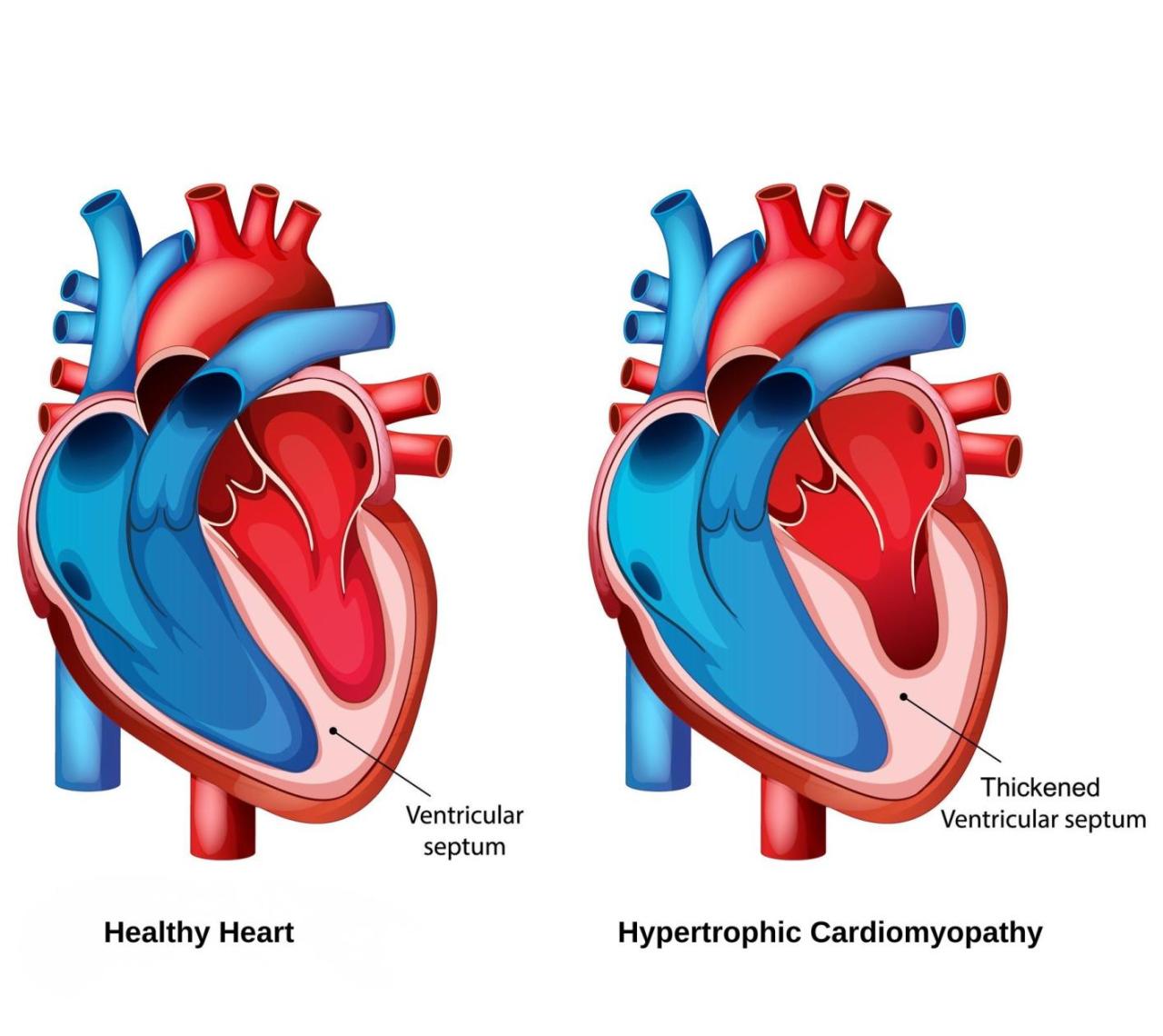 What Comes Next: Hypertrophic Cardiomyopathy | Division of Cardiology