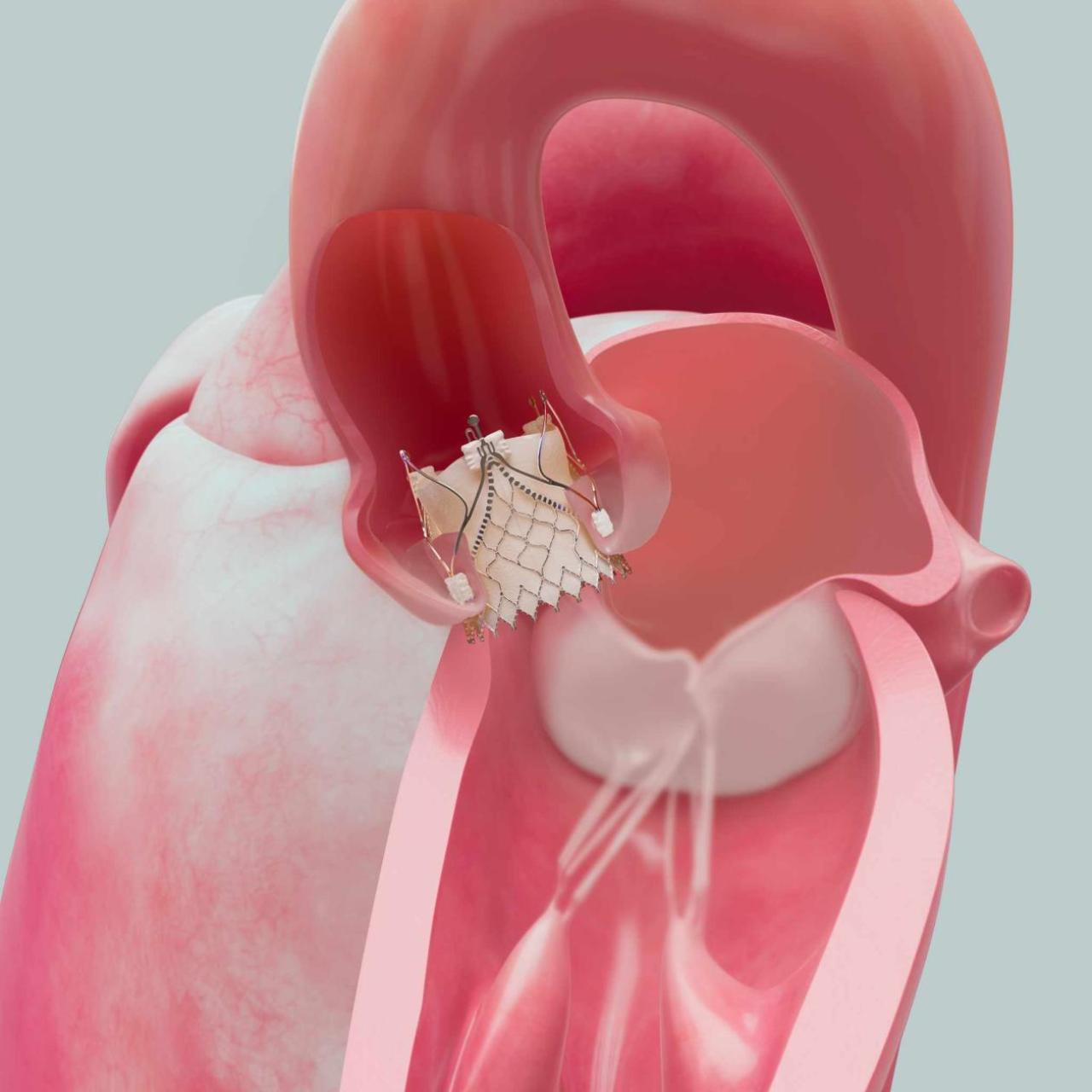 A New Spin on TAVR | Division of Cardiology