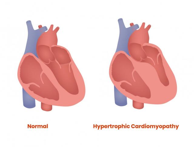 Hypertrophic Cardiomyopathy Treatment - NYC | Division of Cardiology